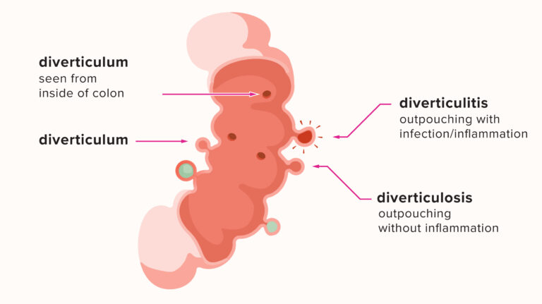 Diverticular & Diverticulitis Treatment | Dr Neil Galletly